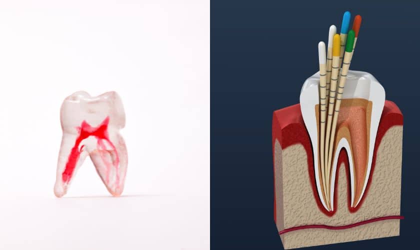 When to Consider Endodontic Retreatment?
